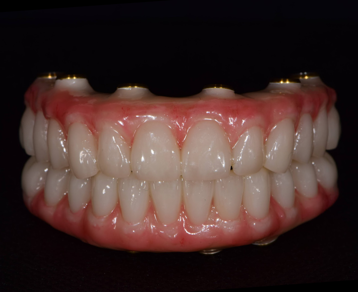 OPTISPLINT Intraoral Full Arch Scanning for All-on-X – Digital Arches LLC