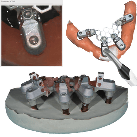 OPTISPLINT Intraoral Full Arch Scanning for All-on-X – Digital Arches LLC